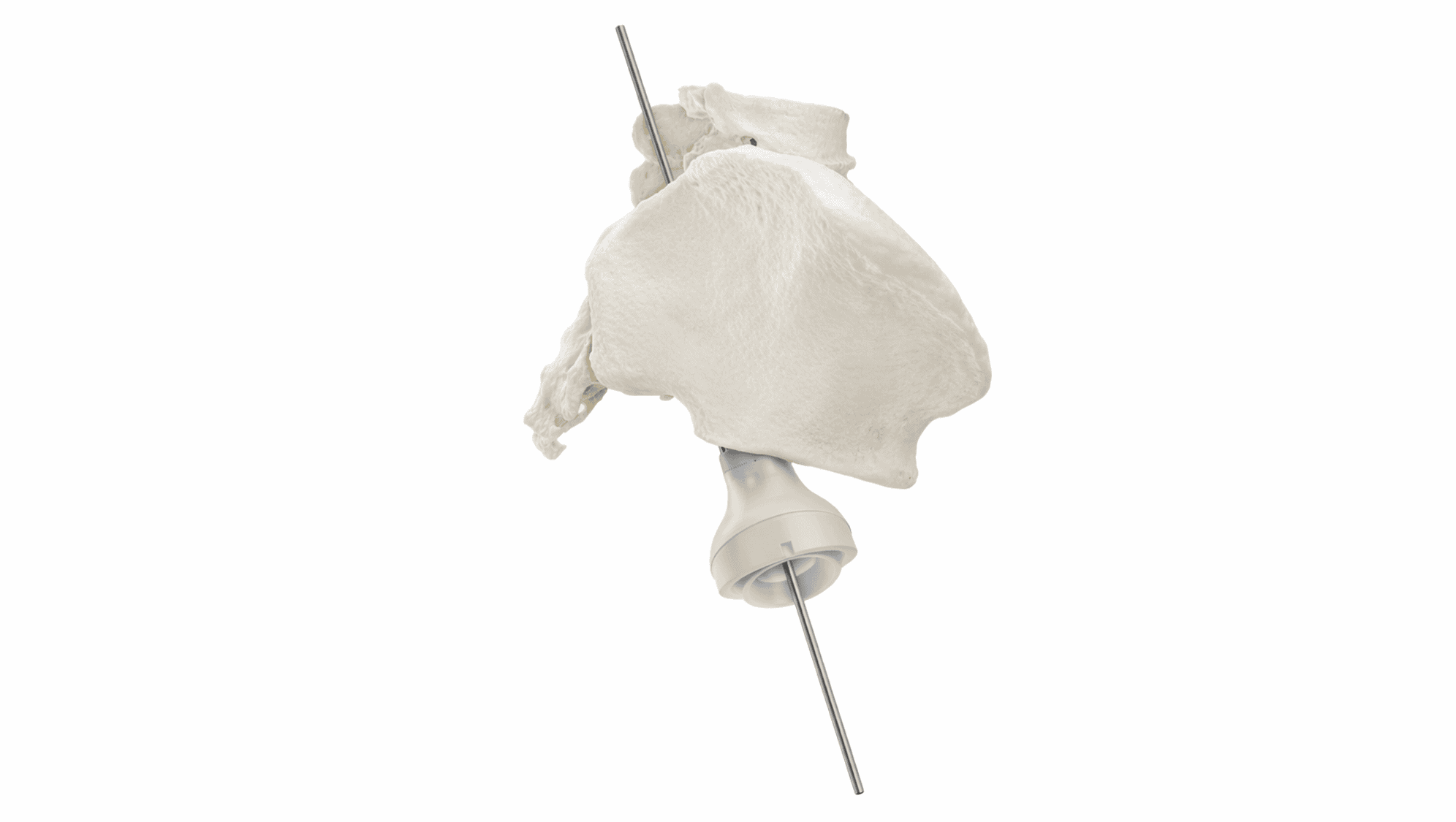 LUMiC for Right Pelvic Angiosarcoma – Insight Surgery